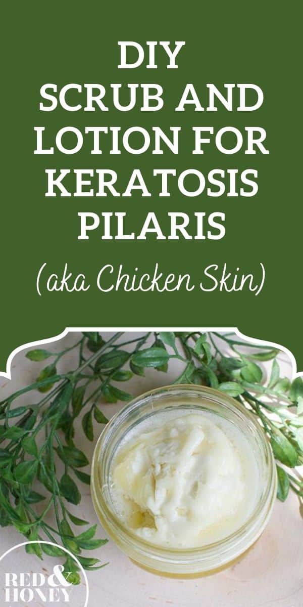 DIY Scrub and Lotion for Keratosis Pilaris (“Chicken Skin”) - Red and Honey