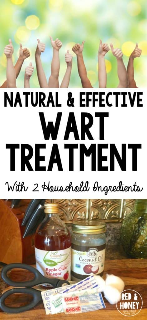 Healthy Children: Natural Wart Remedy (Just 2 Household Ingredients!)