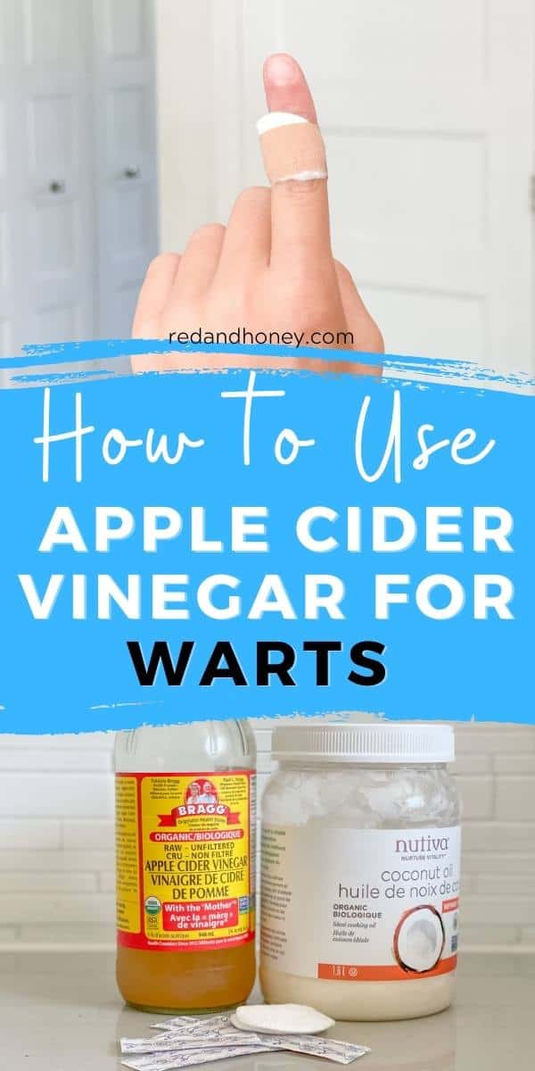 How to Use Apple Cider Vinegar for Warts (Effective Home Remedy)